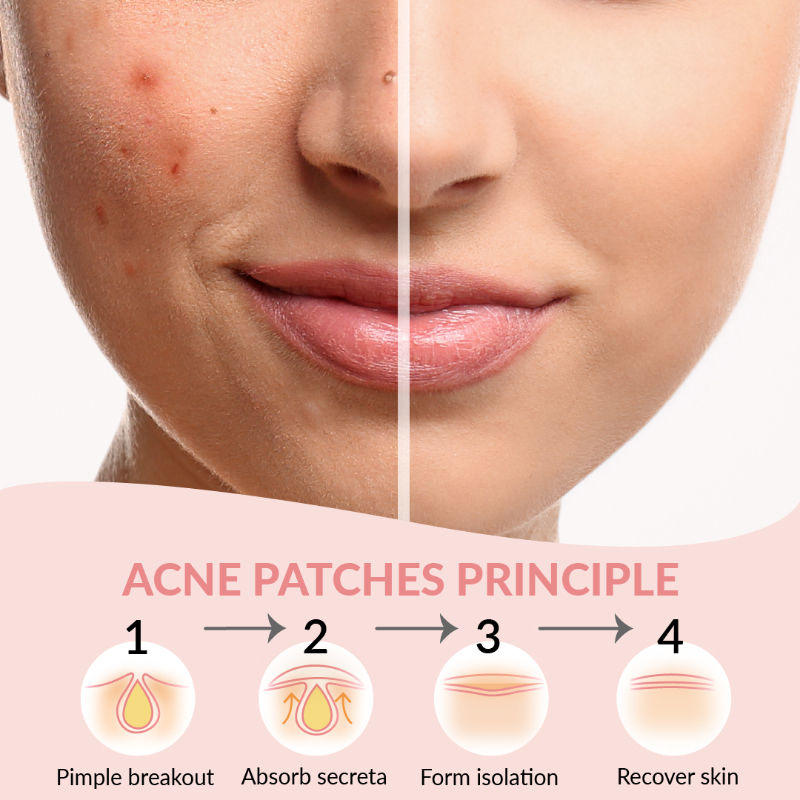 Priveda Acne Pimple Patch: Buy Priveda Acne Pimple Patch Online at Best ...