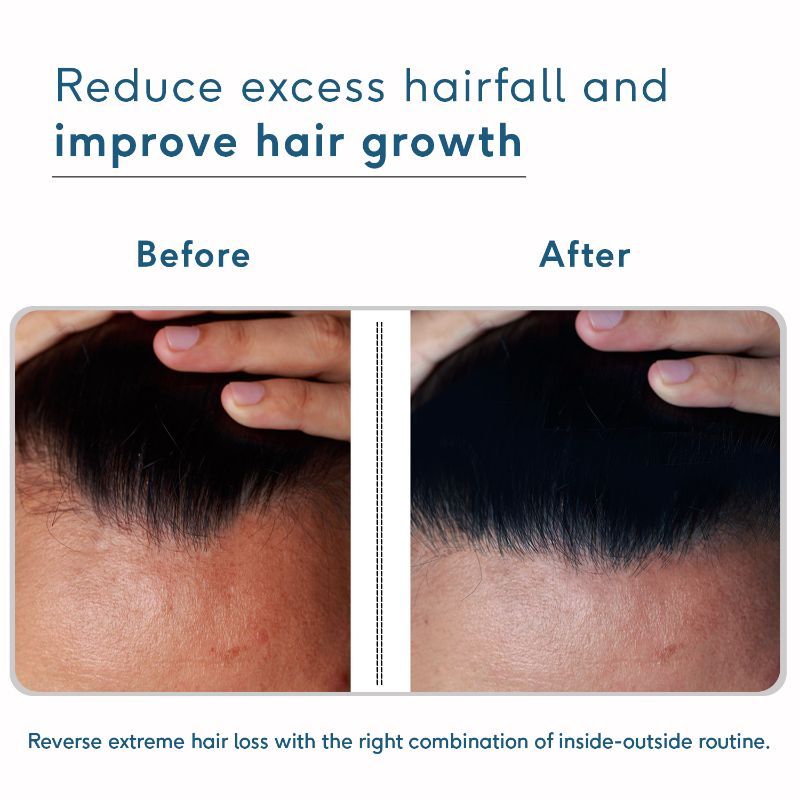 HealthKart HK Vitals Extreme Hairfall Kit For Men - DHT Blocker, Biotin ...