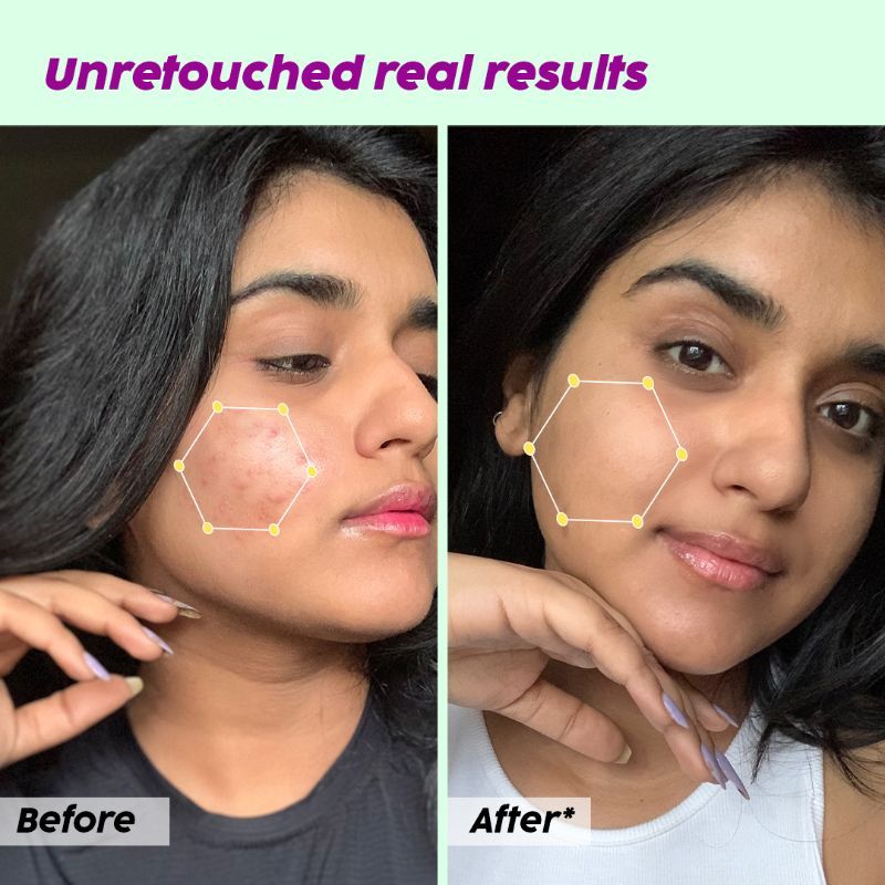 Buy PLIX 2% Salicylic Acid Jamun Active Acne Control Dewy Serum for ...